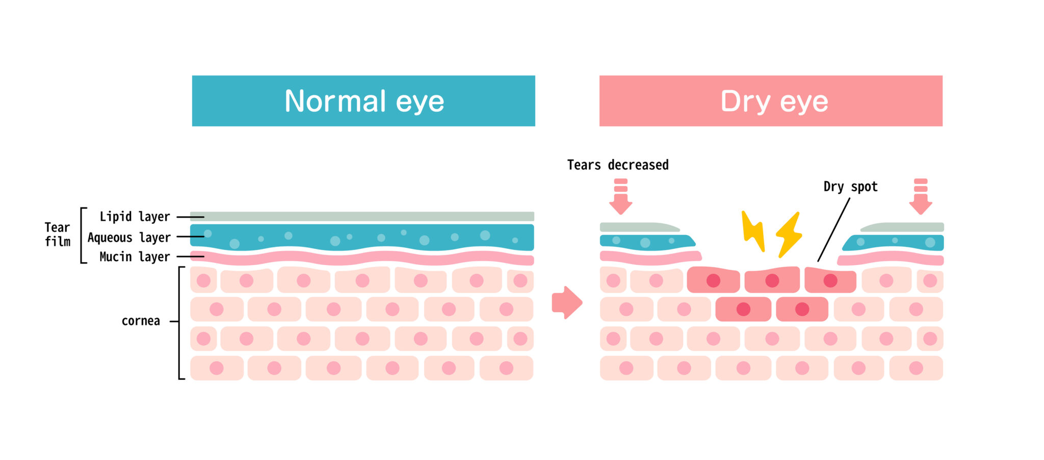 Dry Eye Treatment | Tyler, Athens & Longview, TX | Heaton Eye Associates